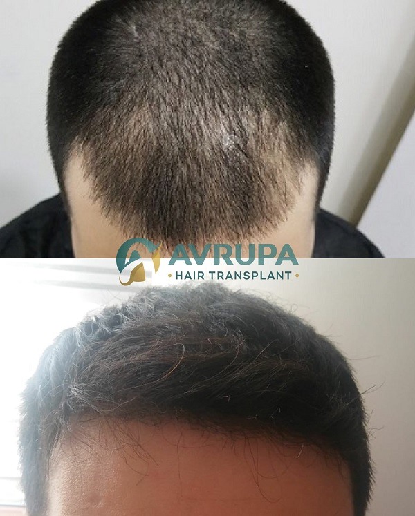 Your Full Guide for Unshaven Hair Transplant | Avrupa Hair Transplant