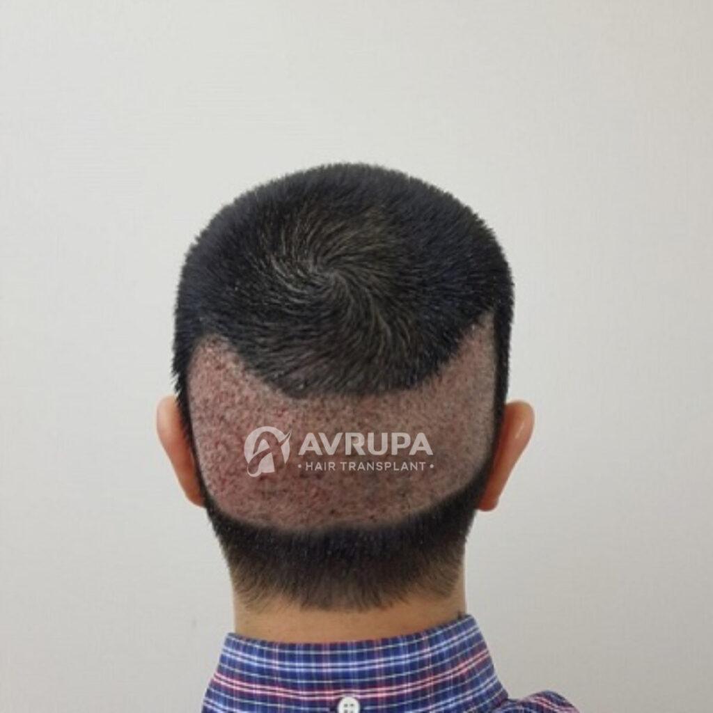 Your Full Guide for Unshaven Hair Transplant | Avrupa Hair Transplant