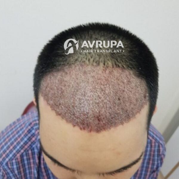 Your Full Guide for Unshaven Hair Transplant | Avrupa Hair Transplant