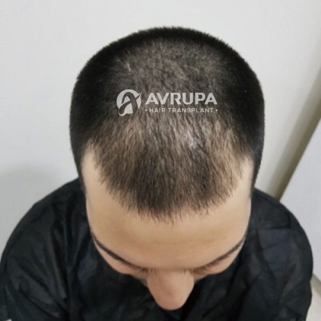 Your Full Guide for Unshaven Hair Transplant | Avrupa Hair Transplant