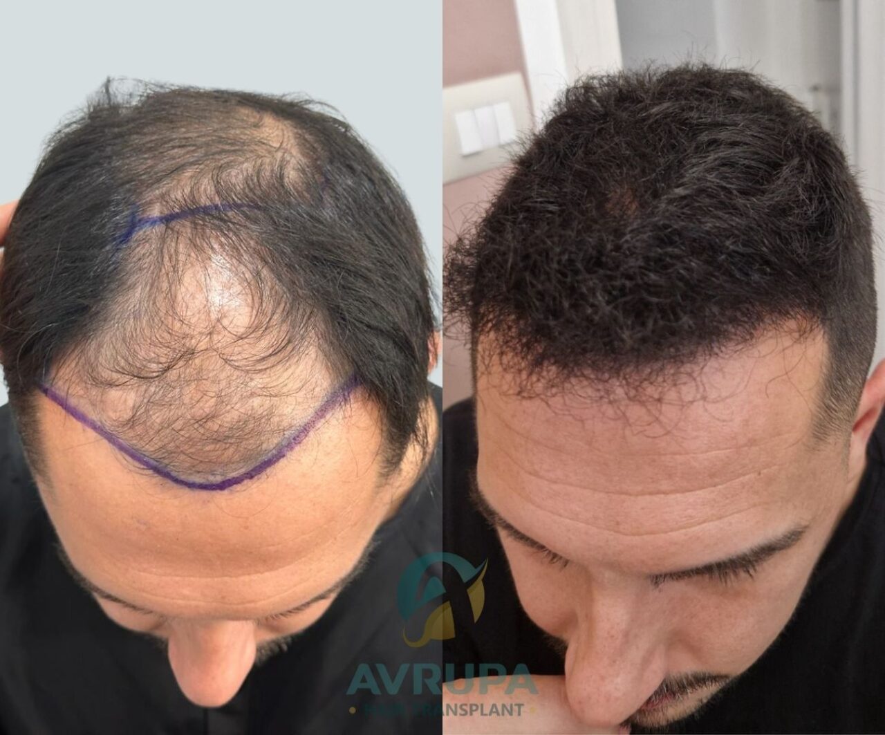The Norwood Hair Scale: Stages, Photos & Treatment Paths